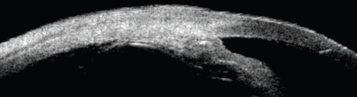 Multimodal Imaging in Uveitis - Retina Today