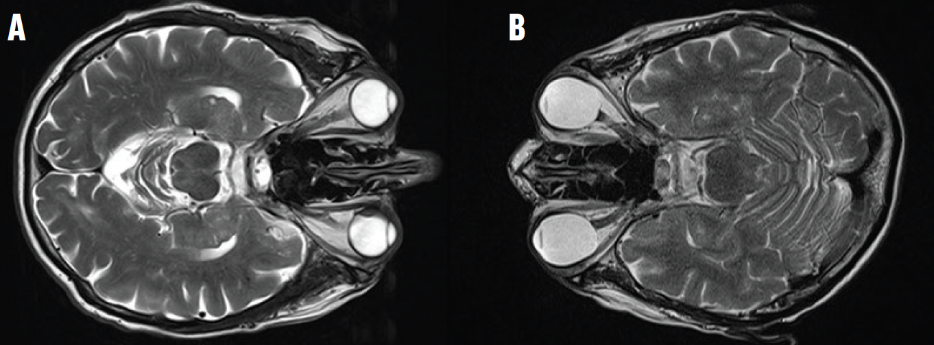 Tailoring IVT Dosing With Vitreous Volume - Retina Today