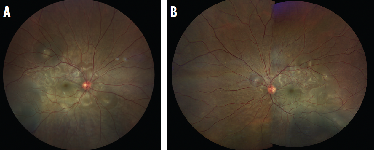 Acute-Onset Vogt-Koyanagi-Harada Syndrome - Retina Today