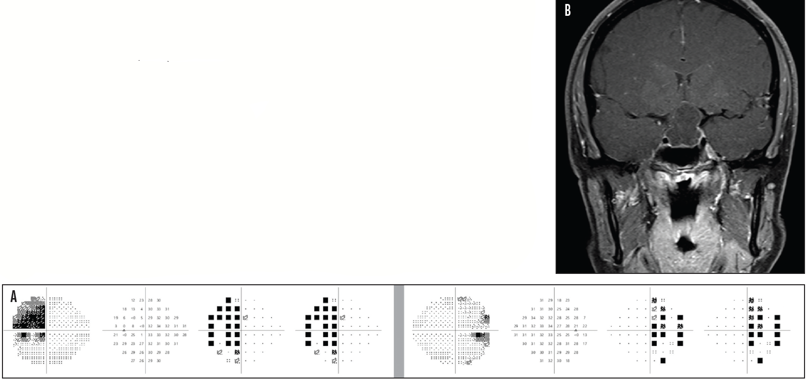 Masqueraders of Normal-Tension Glaucoma - Glaucoma Today