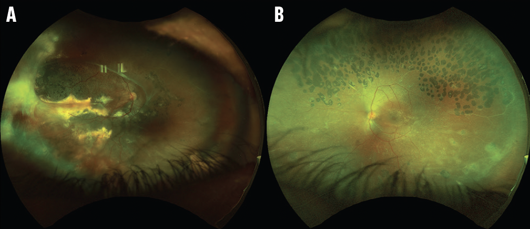 Test Your Diagnostic Acumen: IRD Mystery Cases - Retina Today