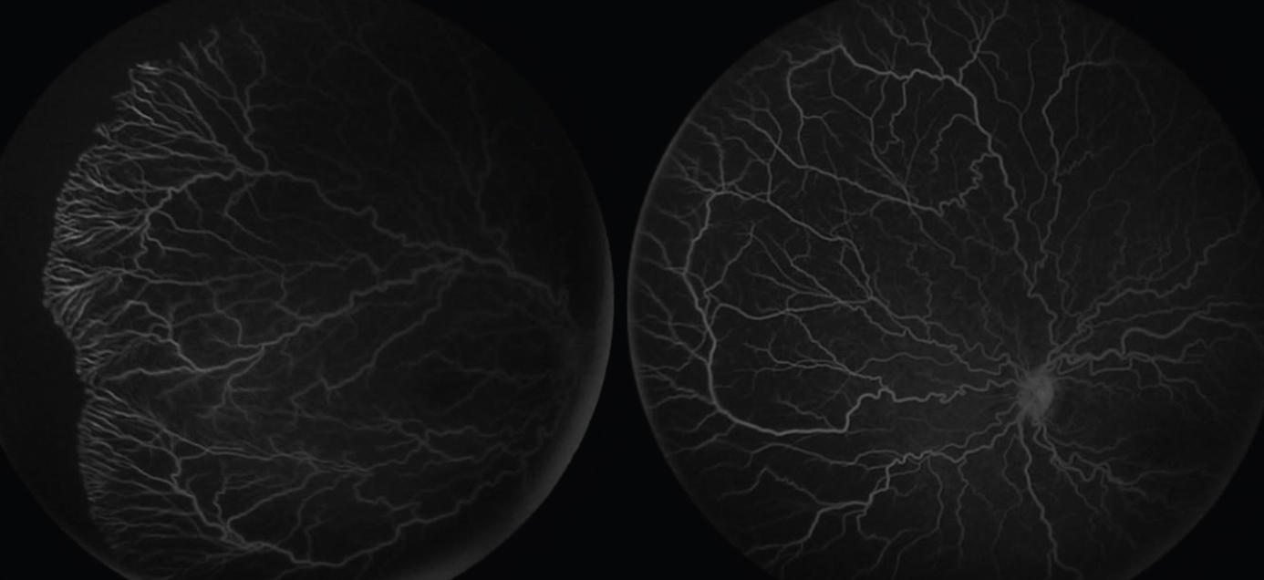 Imaging Tips and Tricks For Retinopathy of Prematurity - Retina Today