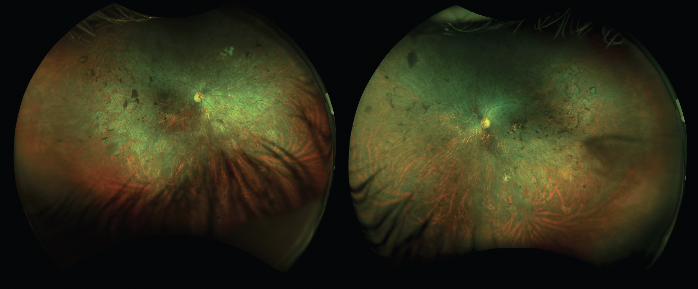 Uncovering ABCA4-Associated Retinopathy - Retina Today