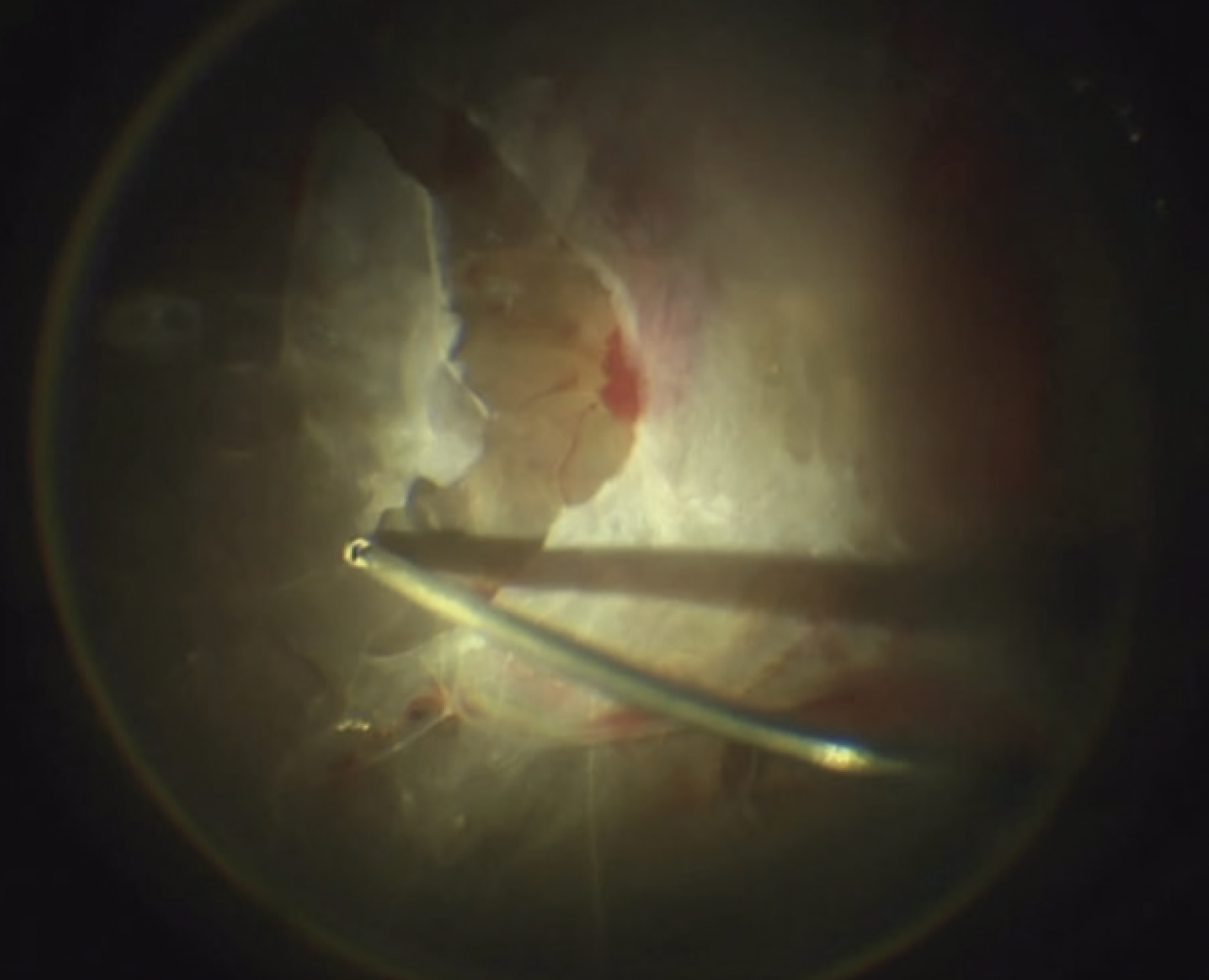 Complicated DR Cases: The Second Surgery - Retina Today