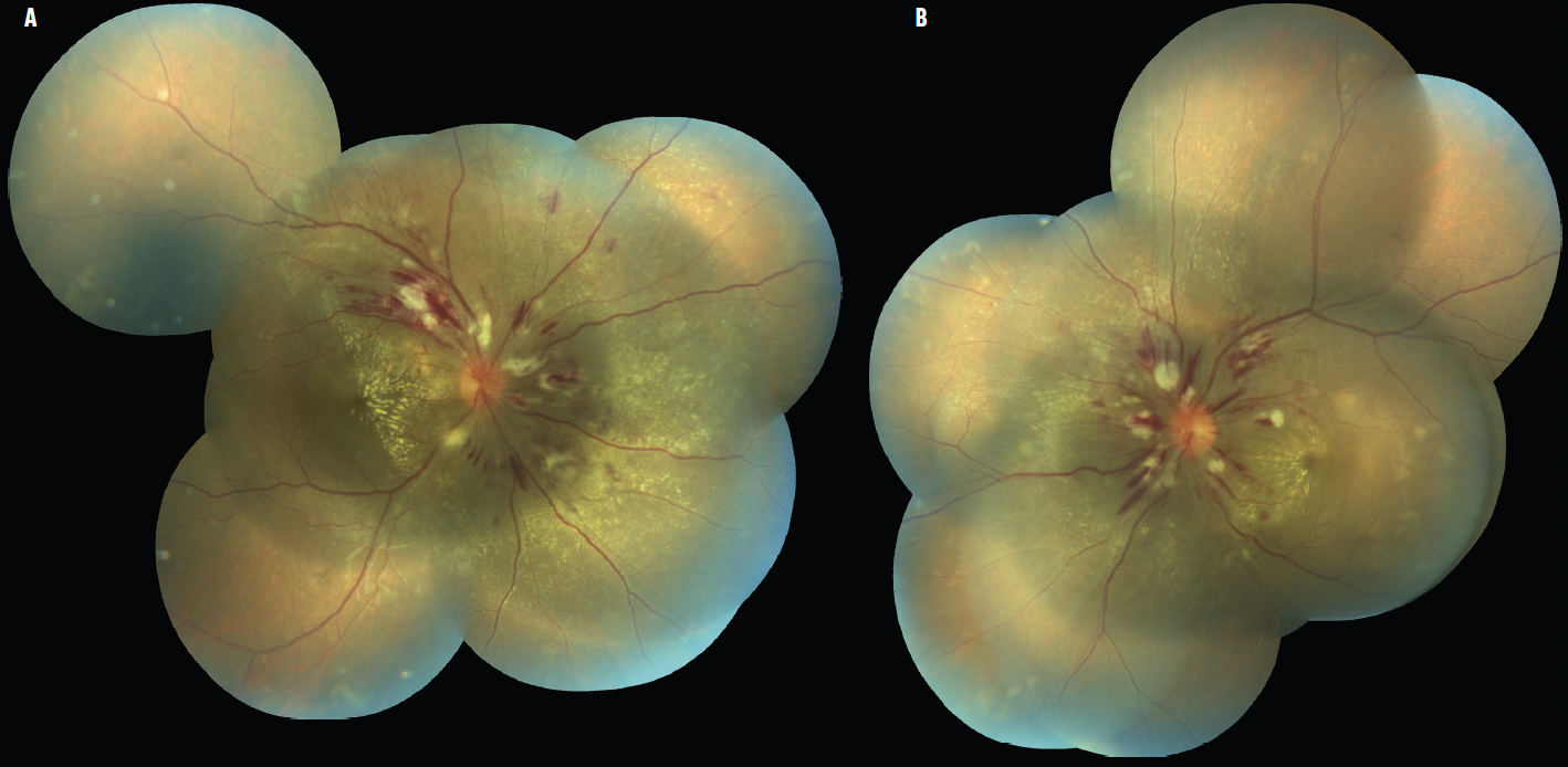 A Complicated Case of Ocular Tuberculosis - Retina Today