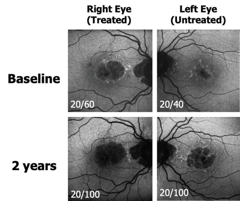 C3 Complement Inhibition Treatment in the Real World - Retina Today