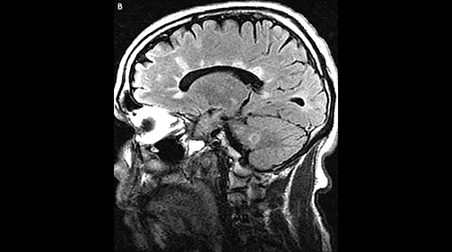 Medial Longitudinal Fasciculus Lesions - The Neurology Hub