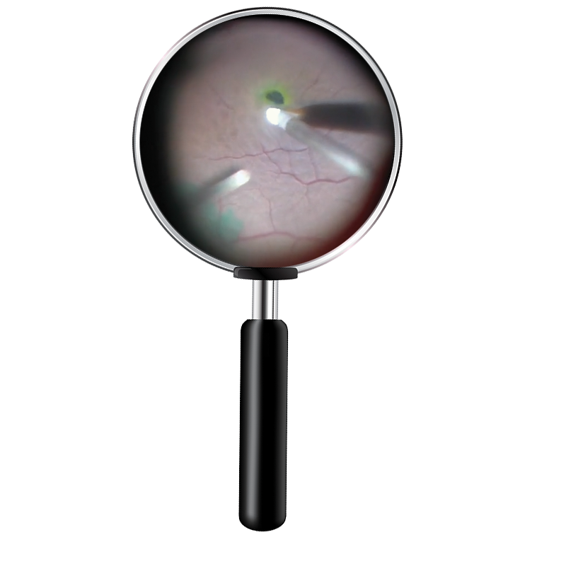 Scleral Buckle Placement Using Chandelier Illumination for a Macula ...