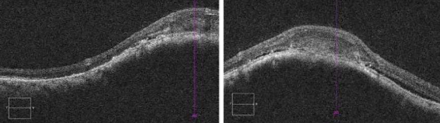 Anterior Signs of a Posterior Problem - Retina Today
