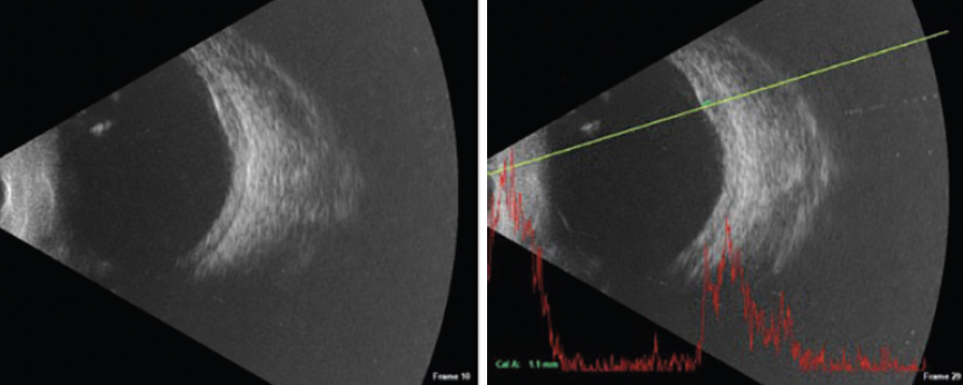 Anterior Signs of a Posterior Problem - Retina Today