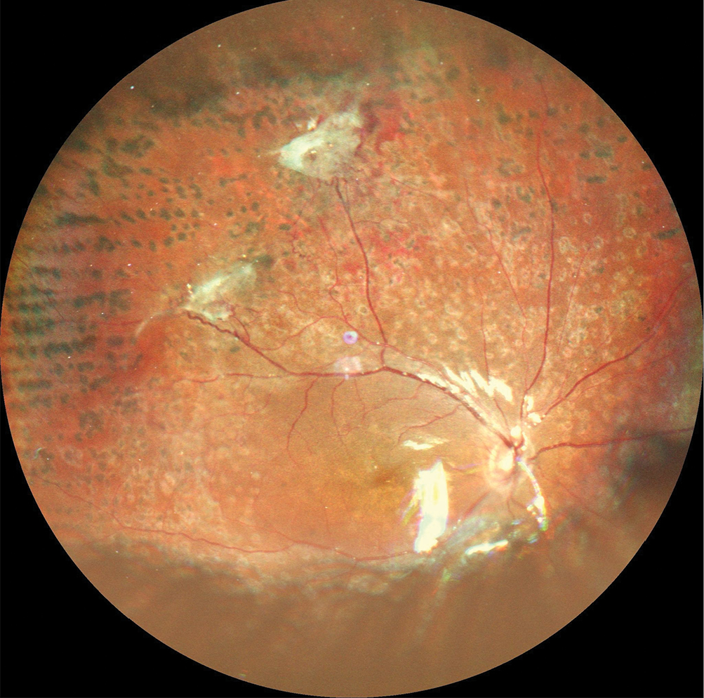 DIABETIC RETINOPATHY: 20/25, for How Long? - Retina Today