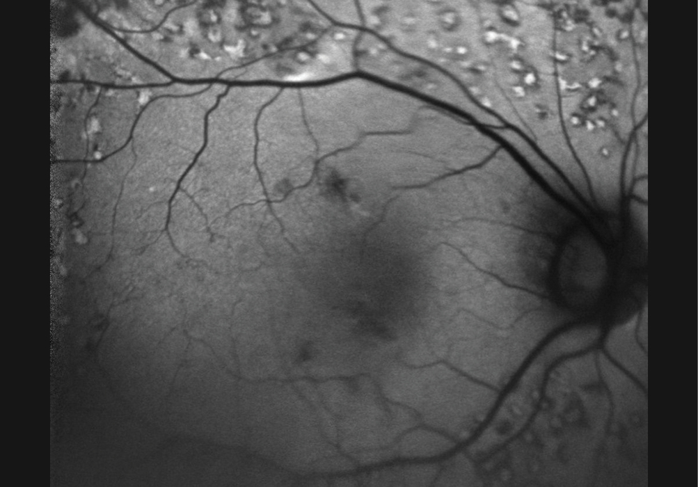 DIABETIC RETINOPATHY: 20/25, for How Long? - Retina Today
