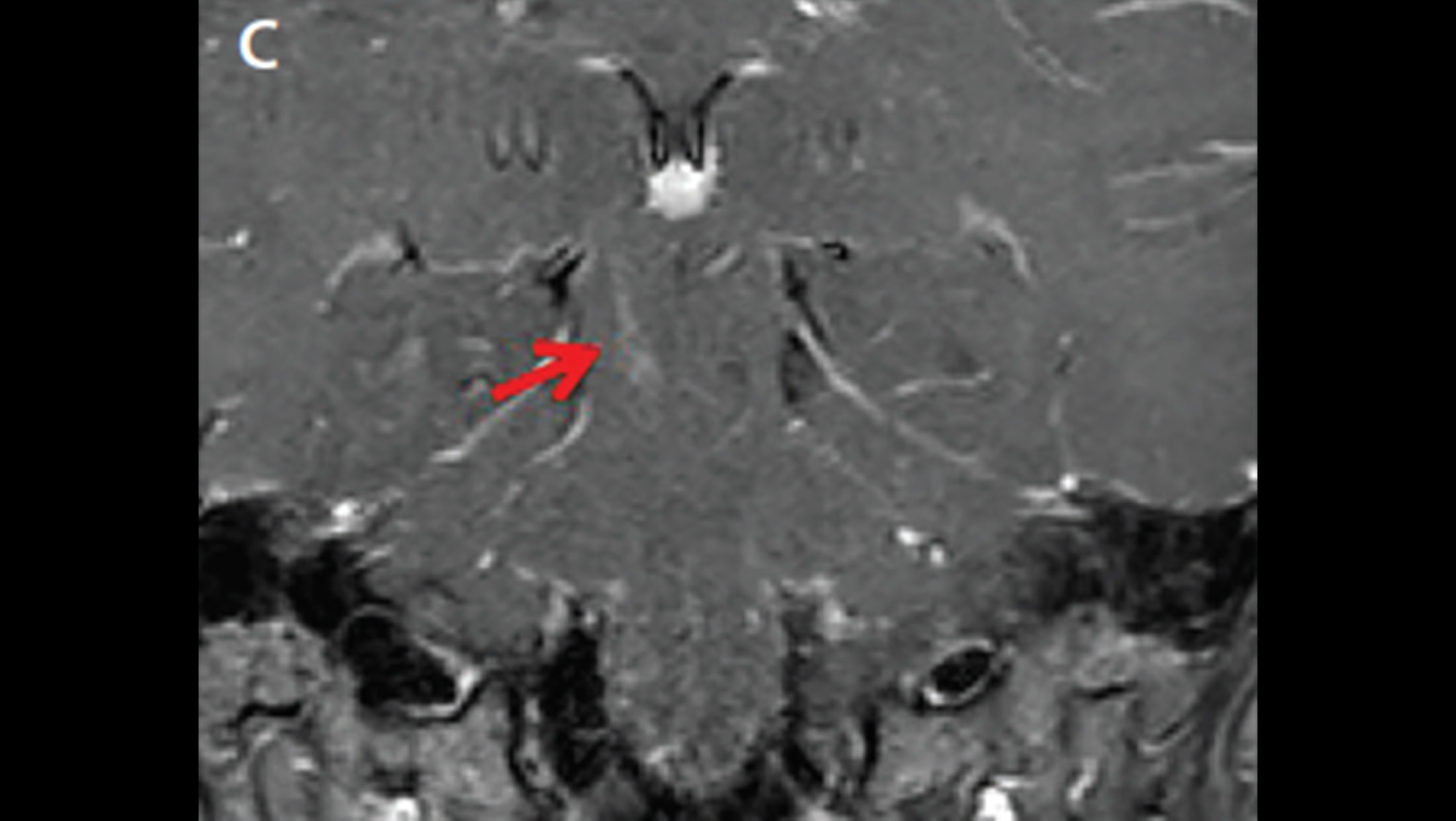 Other Brainstem Lesions - The Neurology Hub
