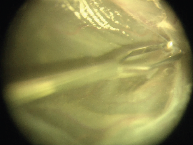 Chronic Combined Tractional and Rhegmatogenous Retinal Detachment ...