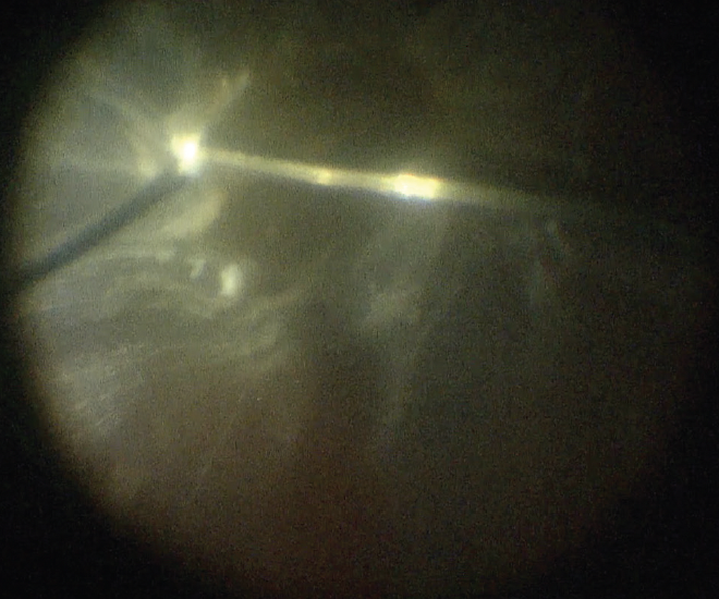 Chronic Combined Tractional and Rhegmatogenous Retinal Detachment ...