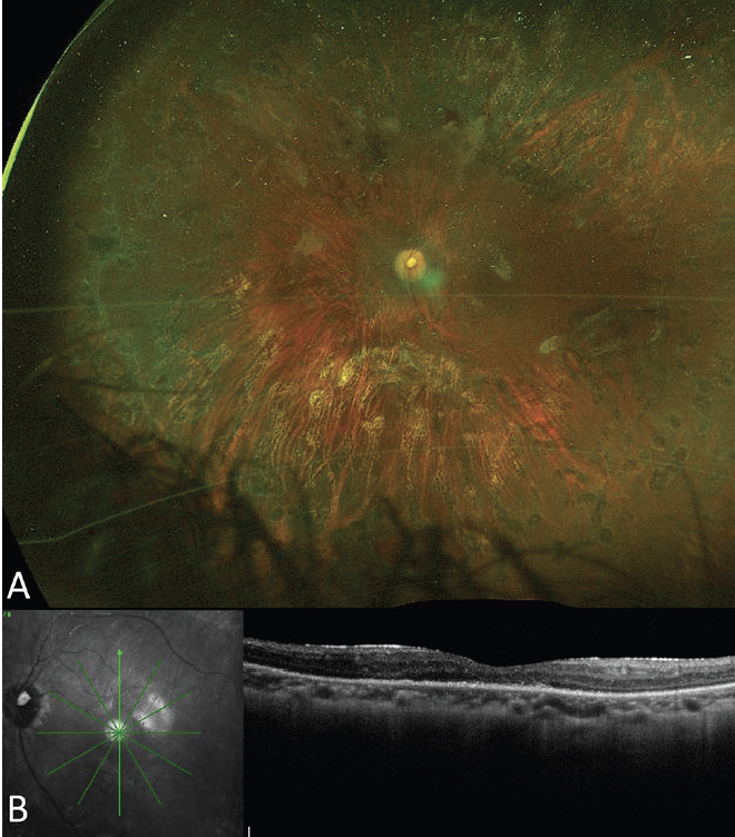 Chronic Combined Tractional and Rhegmatogenous Retinal Detachment ...