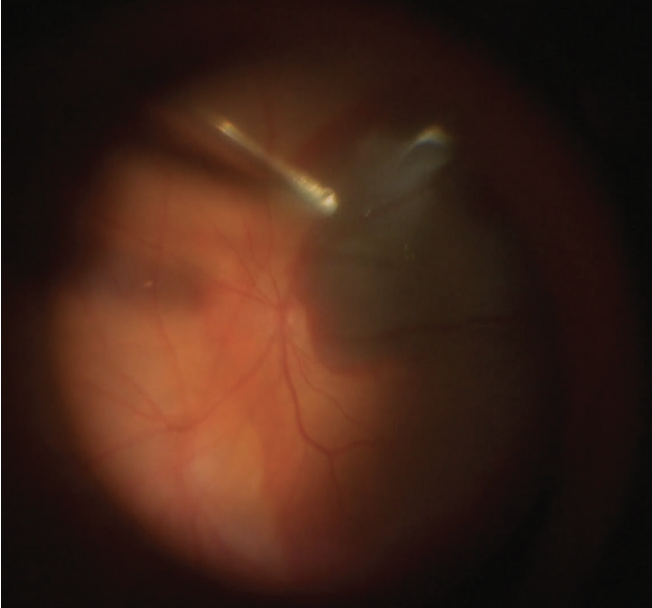 Subretinal Tissue Plasminogen Activator (tPA) for the Treatment of ...