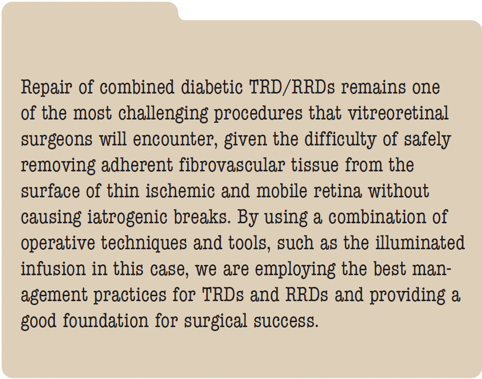 Chronic Combined Tractional and Rhegmatogenous Retinal Detachment ...