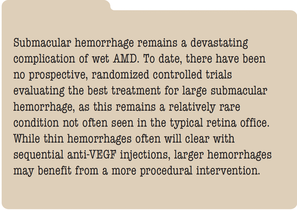 Subretinal Tissue Plasminogen Activator (tPA) for the Treatment of ...