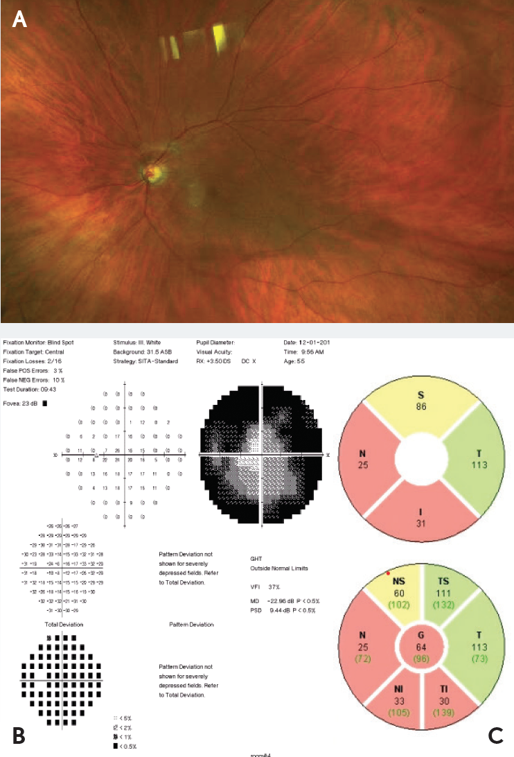 Providing Inflammatory Control in a Patient With Sympathetic Ophthalmia ...