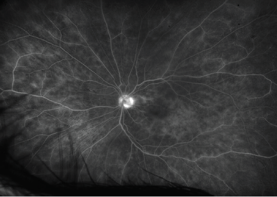 Providing Inflammatory Control in a Patient With Sympathetic Ophthalmia ...