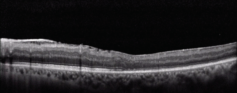 Providing Inflammatory Control in a Patient With Sympathetic Ophthalmia ...