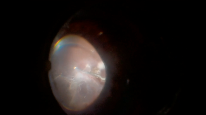 A Severe Case of Tractional Retinal Detachment - Eyetube