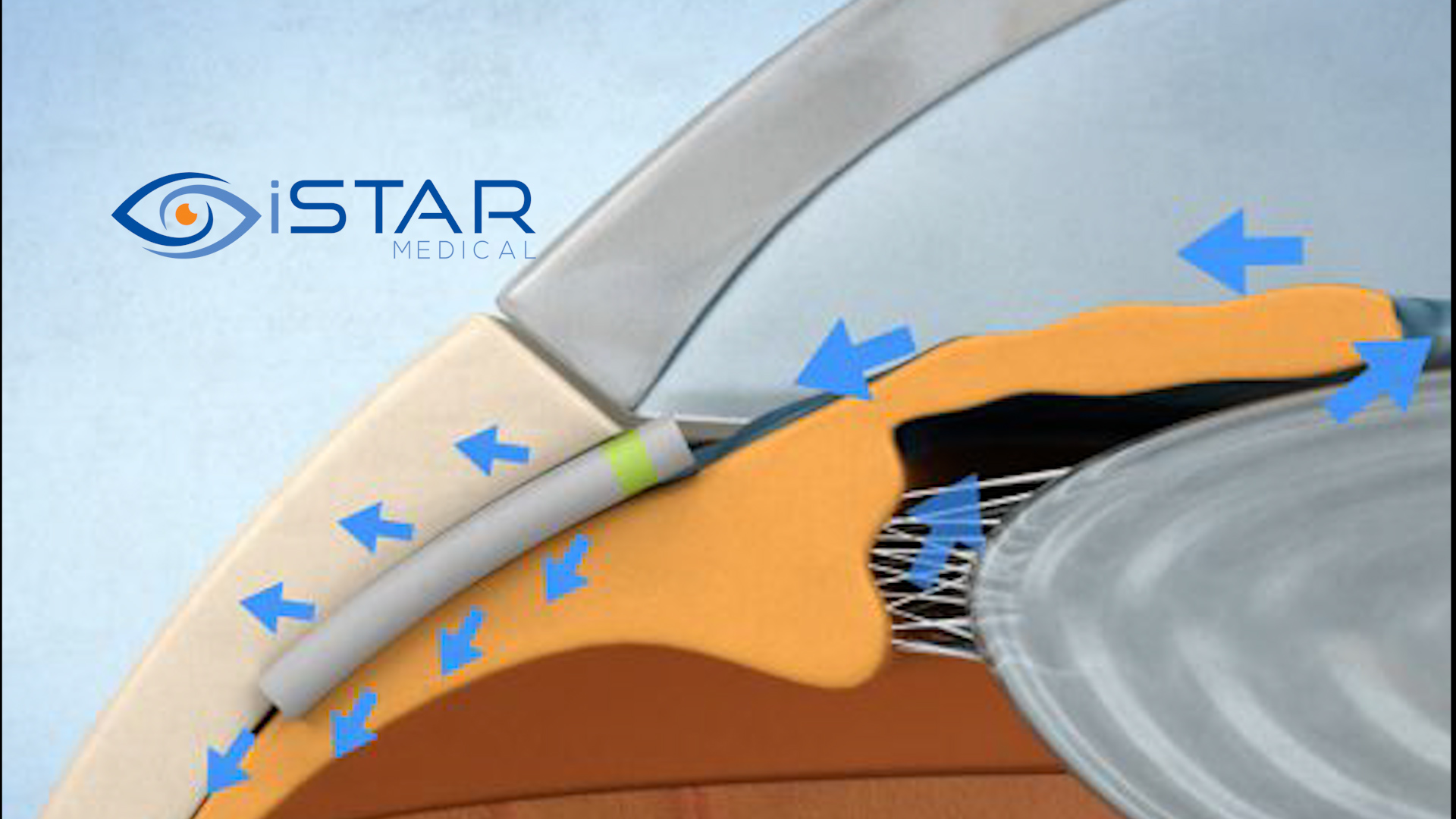 iStar Medical Receives FDA Nod to Begin Trial for MINIject MIGS Device ...