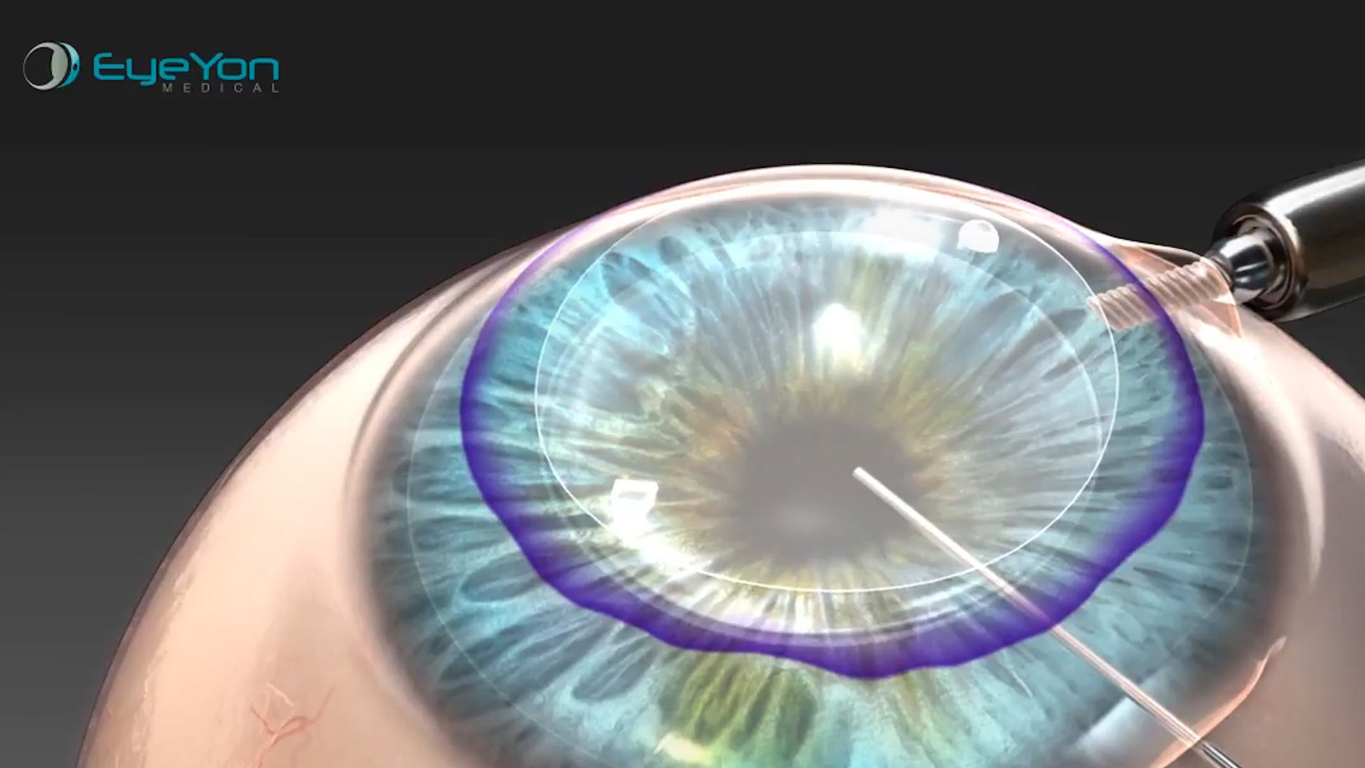 EyeYon Medical Receives CE Mark for EndoArt Implant for Chronic Corneal ...