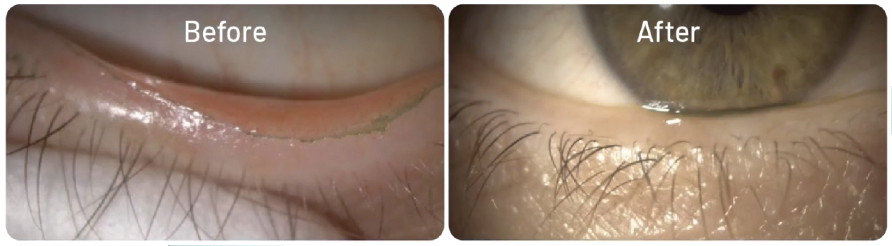 Effectively Treating Demodex Blepharitis - YoungMD Connect