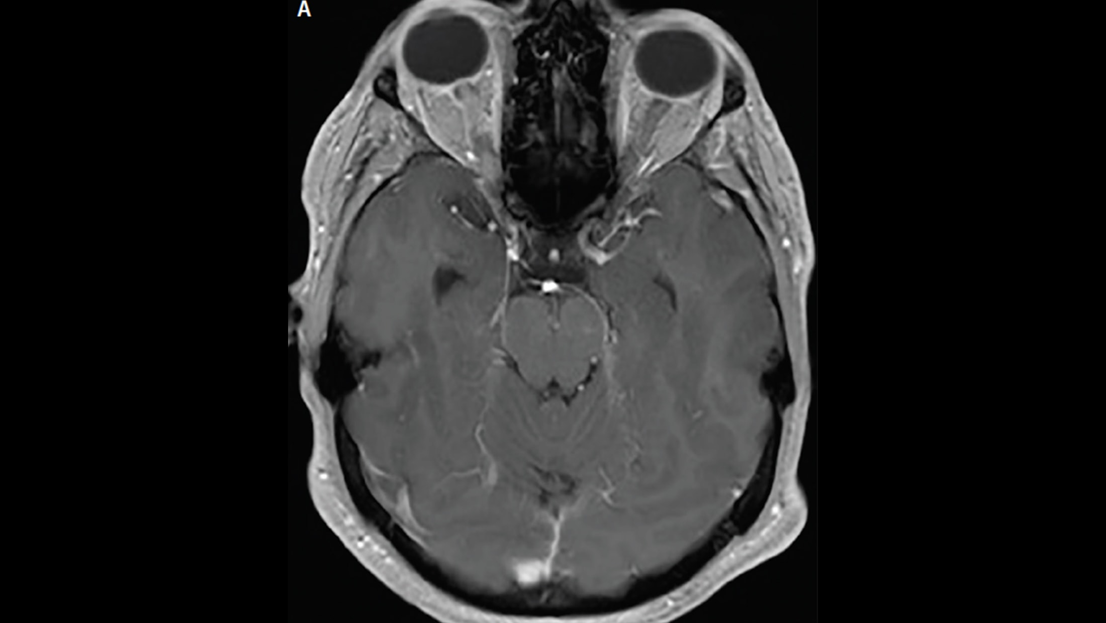 Temporal Lobe Lesions - The Neurology Hub