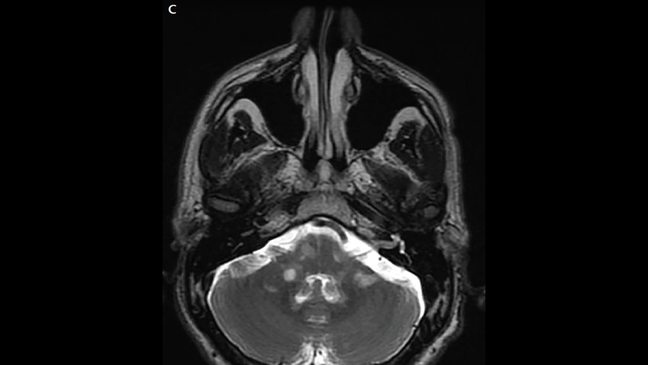 Temporal Lobe Lesions - The Neurology Hub