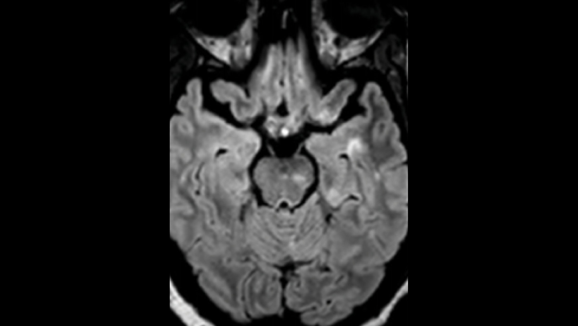 Temporal Lobe Lesions - The Neurology Hub
