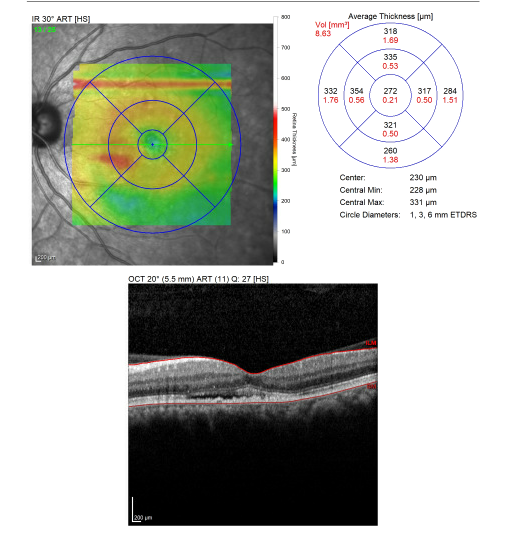 Imaging Basics in AMD - Retina Today