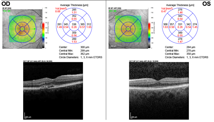 Imaging Basics in AMD - Retina Today